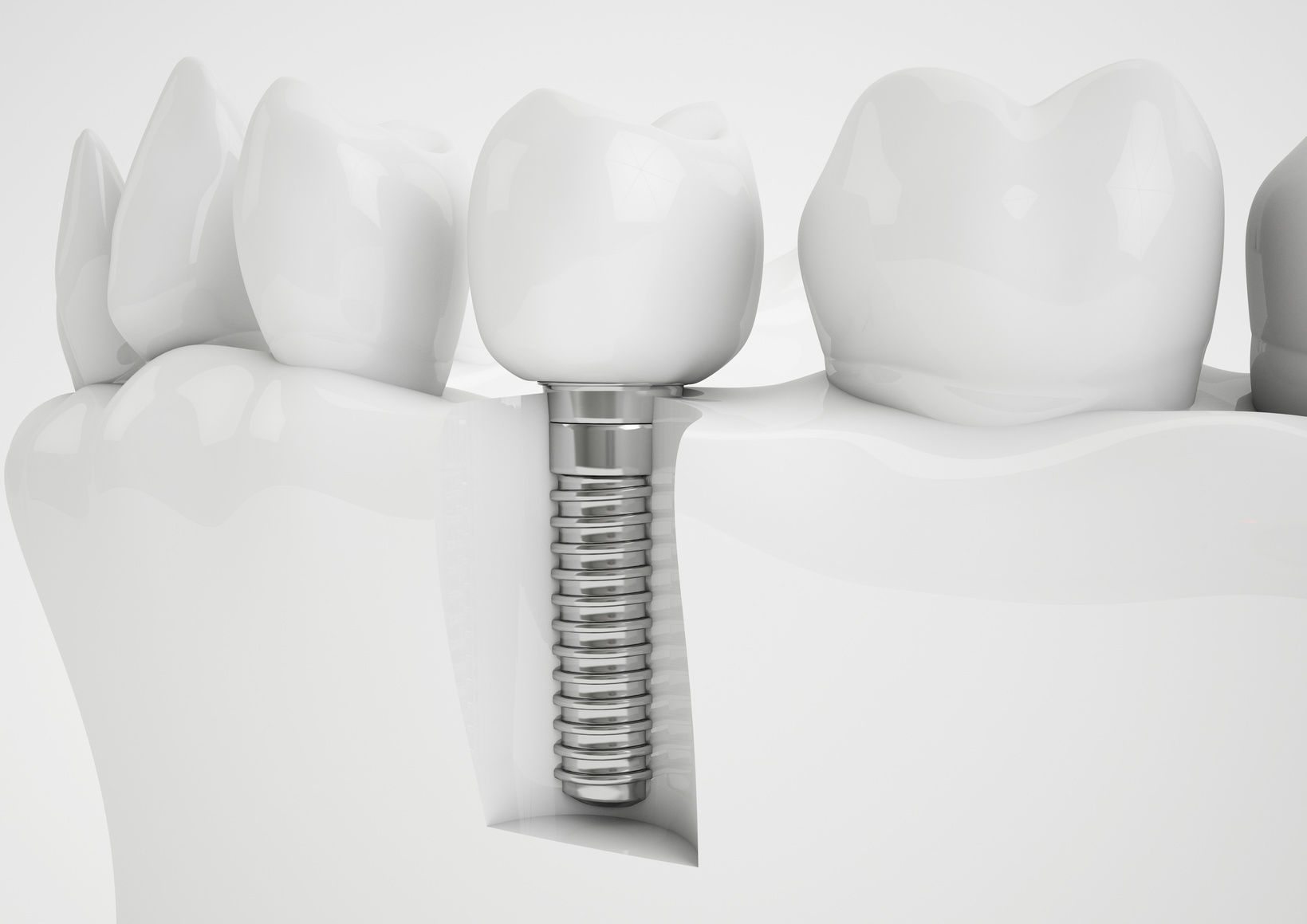 Làm răng Implant - Những trường hợp nên trồng răng Implant!
