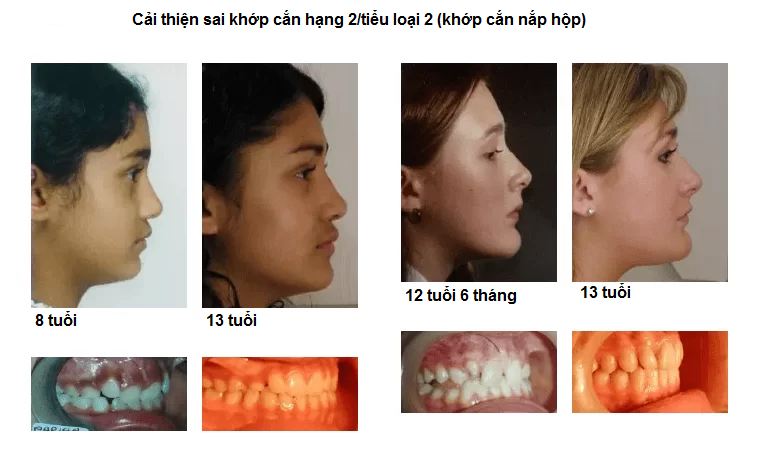 Có bằng chứng khoa học của Mewing không? Tập Mewing có hiệu quả?