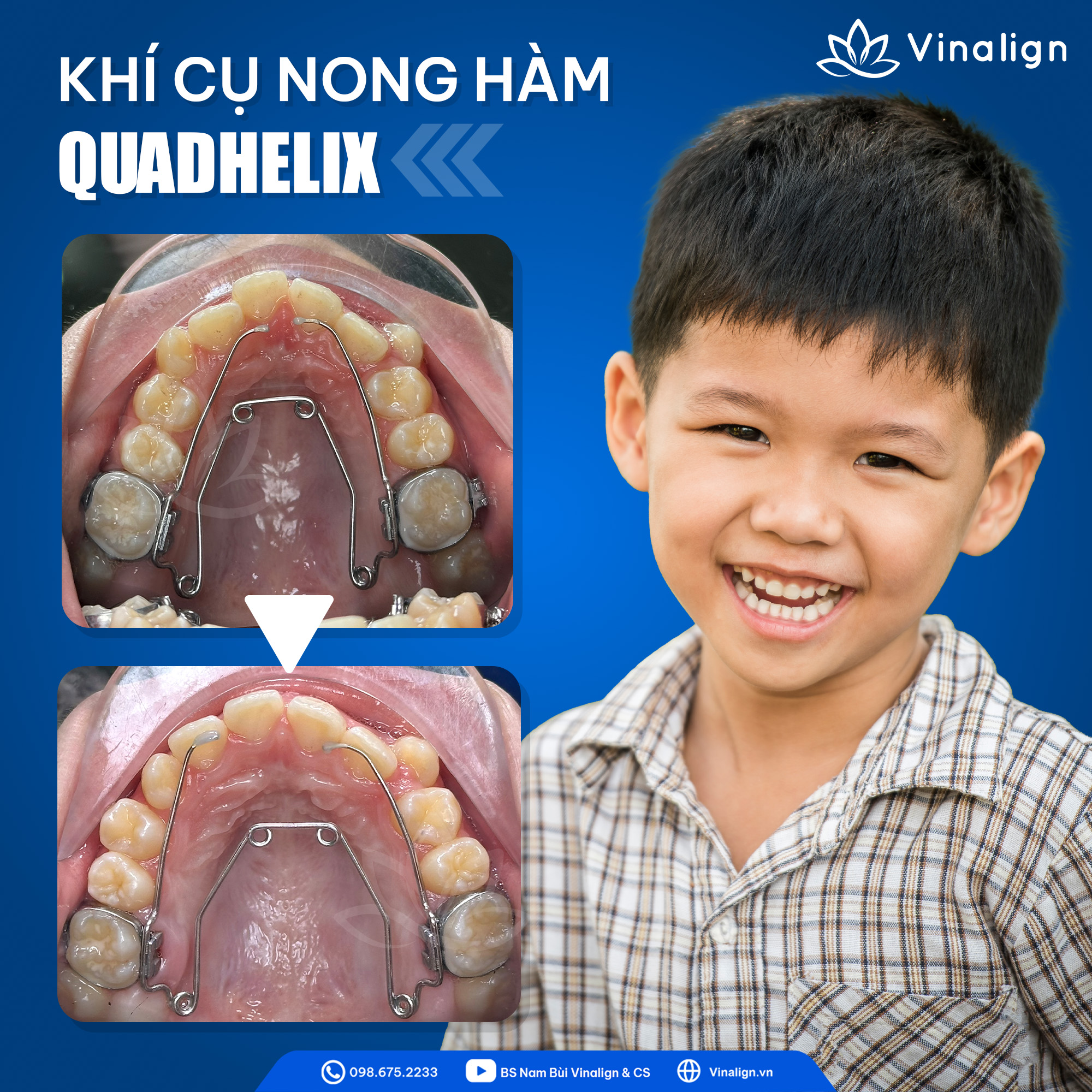 Khí cụ Quad-Helix - Giải pháp nong hàm hiệu quả cho hàm hẹp